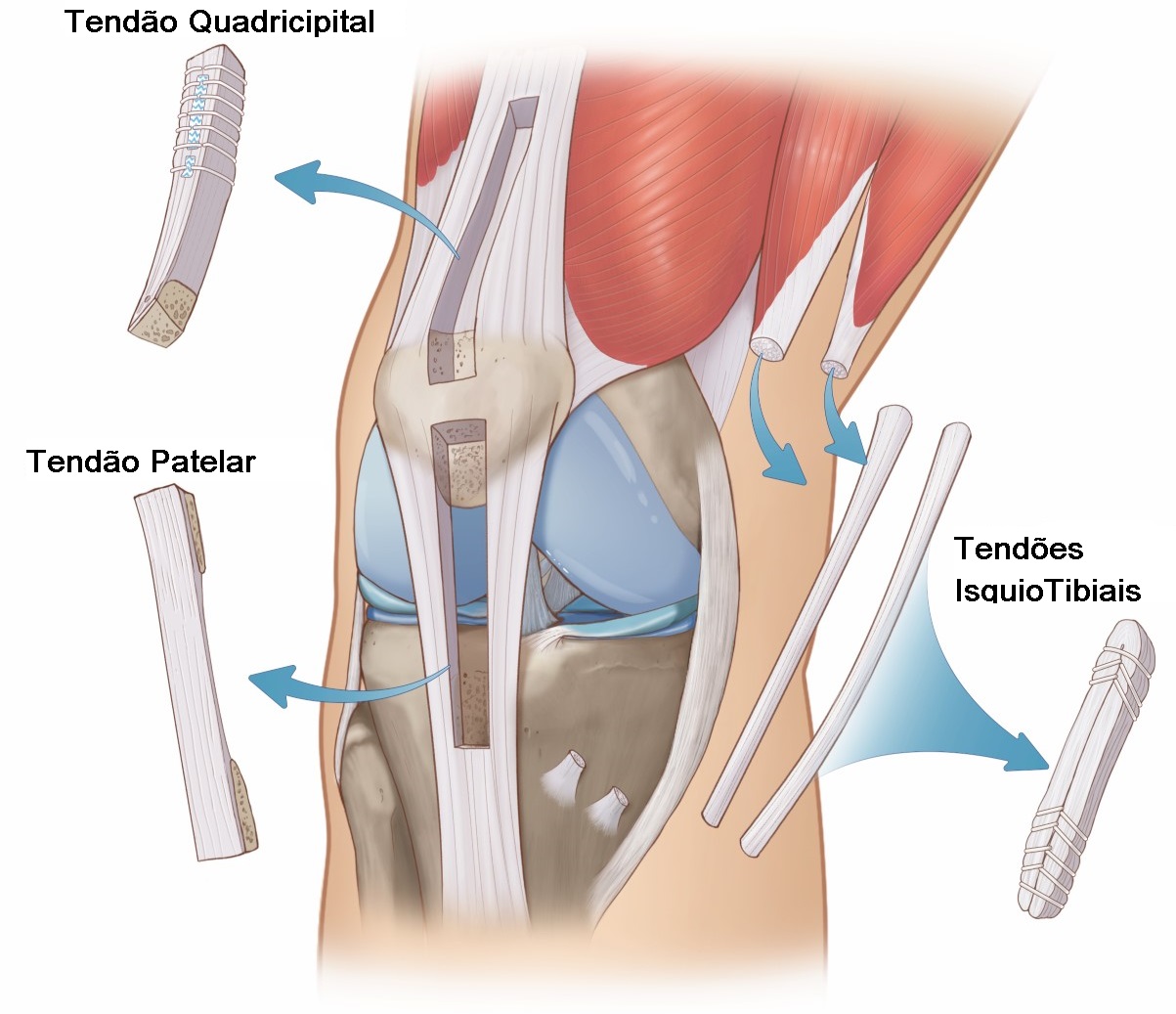 Ligamentos E Tendoes Lesão De Tendão Na Mão Dr Ricardo Kaempf